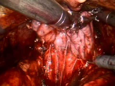Robot Assisted Radical Prostatectomy
