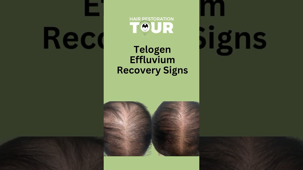 Telogen Effluvium Recovery Signs | ￼ What you should be looking for! #telogeneffluvium