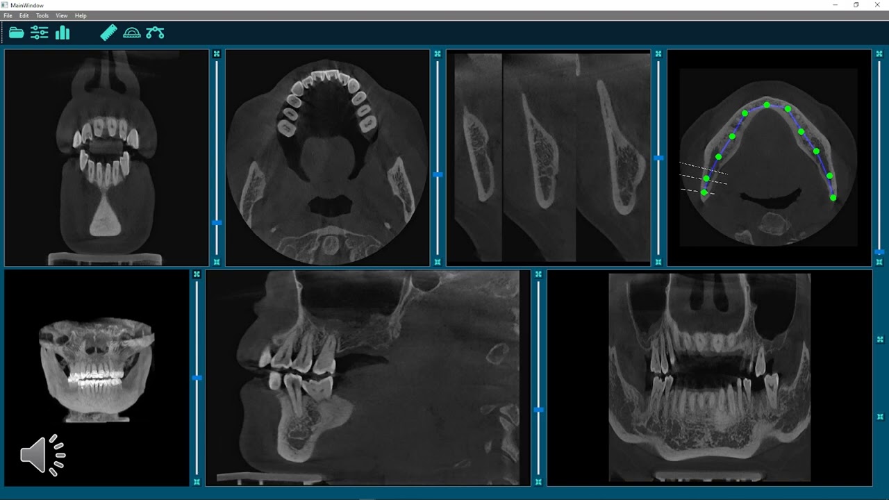 GitHub - noran-seliem/GP-CBCT--mandibular-canal-detection