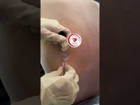 #shorts #thoracentesis #emergencymedicine #procedure #pleuraleffusion #ascites