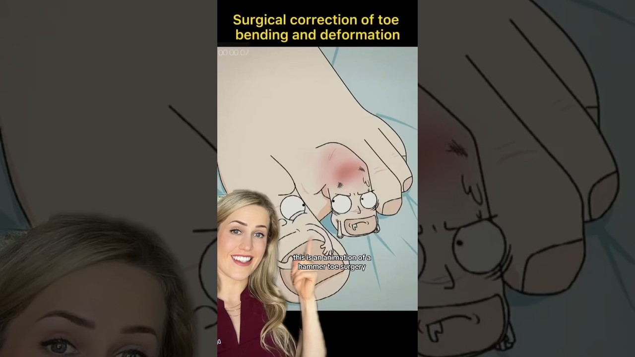 Doctor explains: hammertoe surgery
