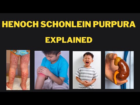 Henoch Schonlein Purpura IgA vasculitis Pathophysiology, presentations, investigations and treatment