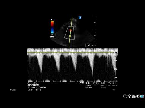 How to... Measure LVOT Obstruction
