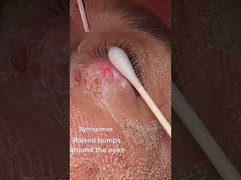 Syringomas Removal #shorts