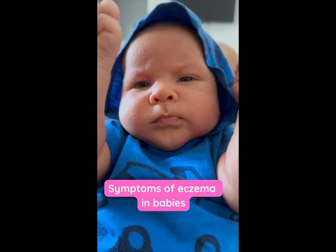 Eczema in babies & children: the causes, symptoms, and treatments