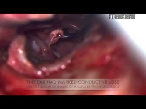 The 'Cobra' - in Otology