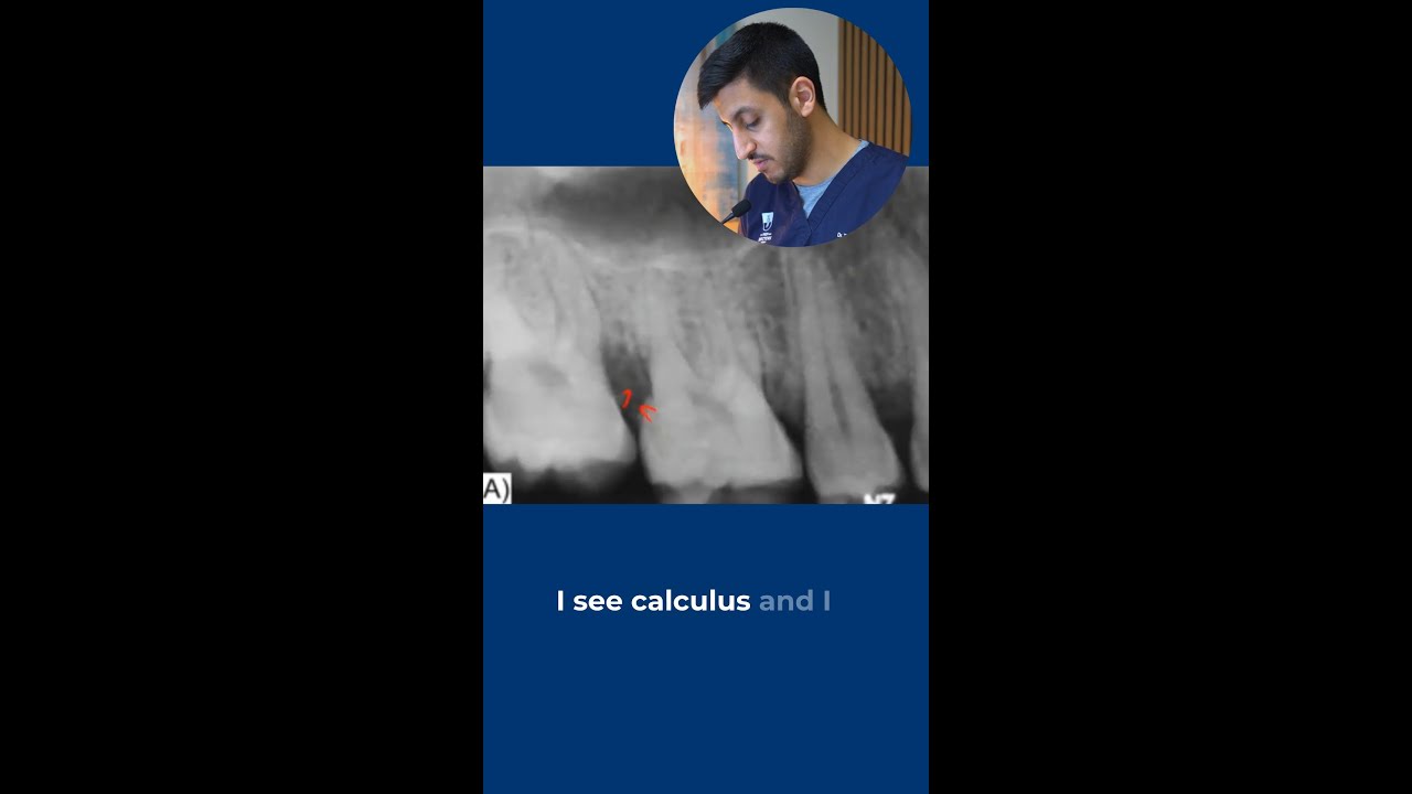 Does the patient meets all the criteria for periodontitis?