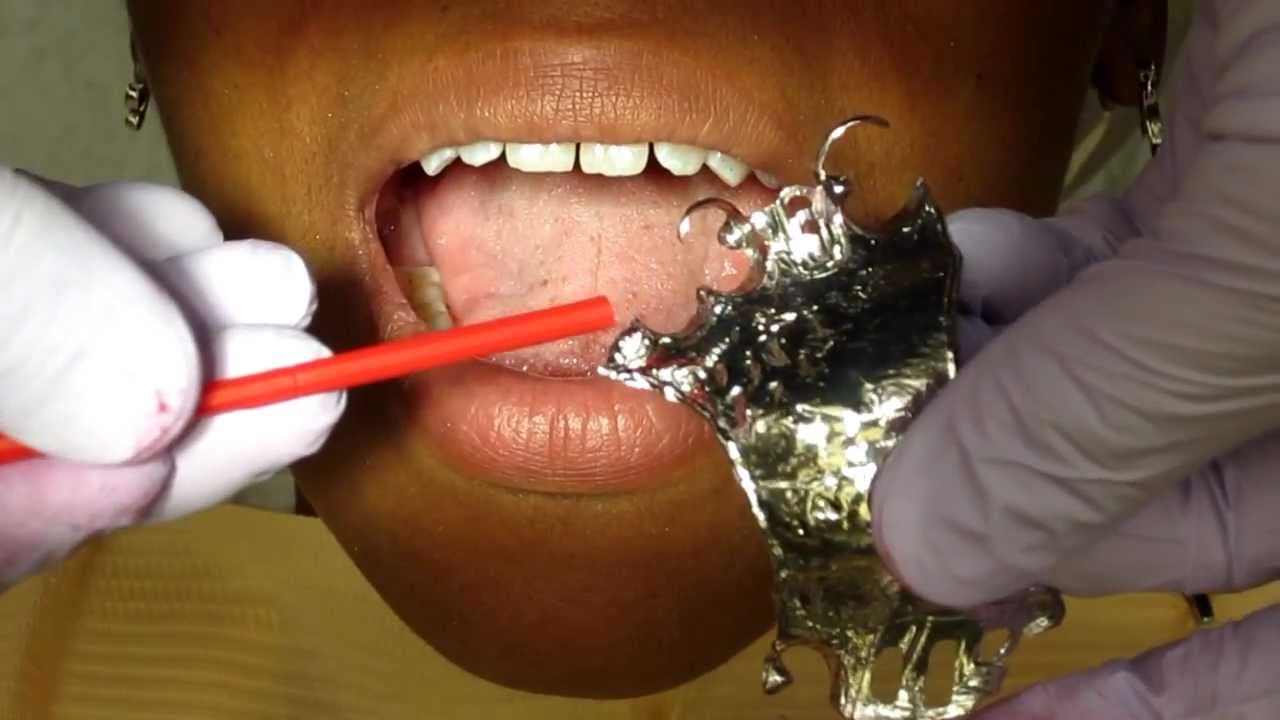 Removable Partial Denture Framework 