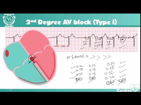 2nd Degree Heart Block Type I - Course Video from EKG Course by NURSING.com (NRSNG)