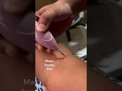 Watch skin tags vanish painlessly with the Veentus Wart Remover Pen! Say goodbye to pesky moles !