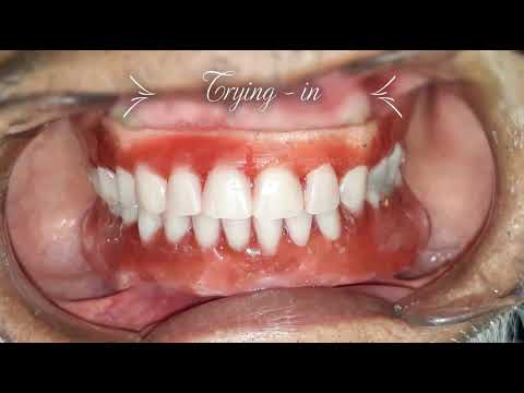 Flangeless Denture