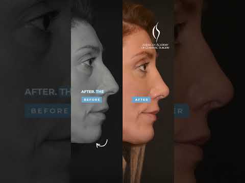Facial Enhancements with Vectra 3D Imaging #co2laser #fattransfer #chinimplant