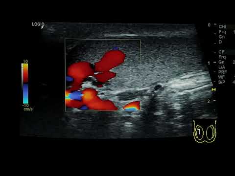 intratesticular varicocele