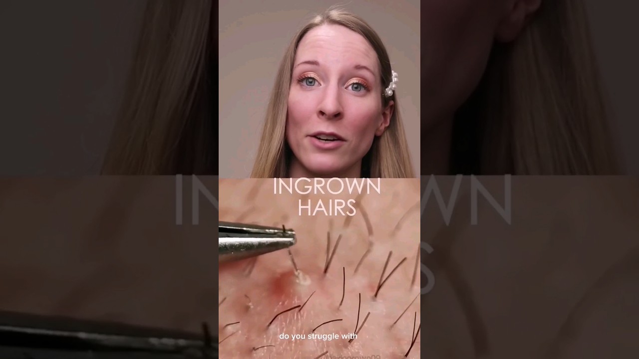 How to Treat Ingrown Hairs. Skin care tips from a dermatologist #dermatology #skin