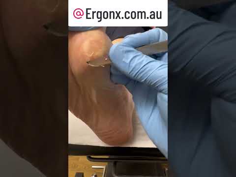 Satisjfying hard skin cutting by podiatrist