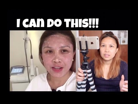 ACNE TREATMENT : 2ND ICON LASER TREATMENT + NEW TRIPOD REVIEW