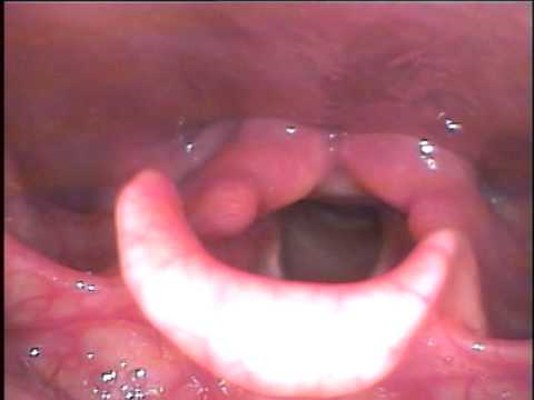 Laringoscopia da Susuh
