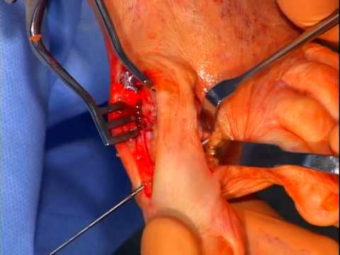 Hallux Varus Correction With MiniTightRope