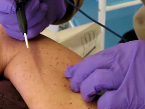 Bristol Cosmetic Plastic Surgery - Mole Removal Radiosurgery