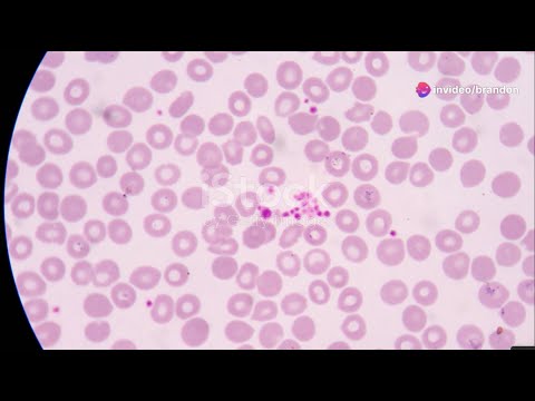 COAGULOPATHIES | VON WILLEBRAND DISEASE (VWD) - 02