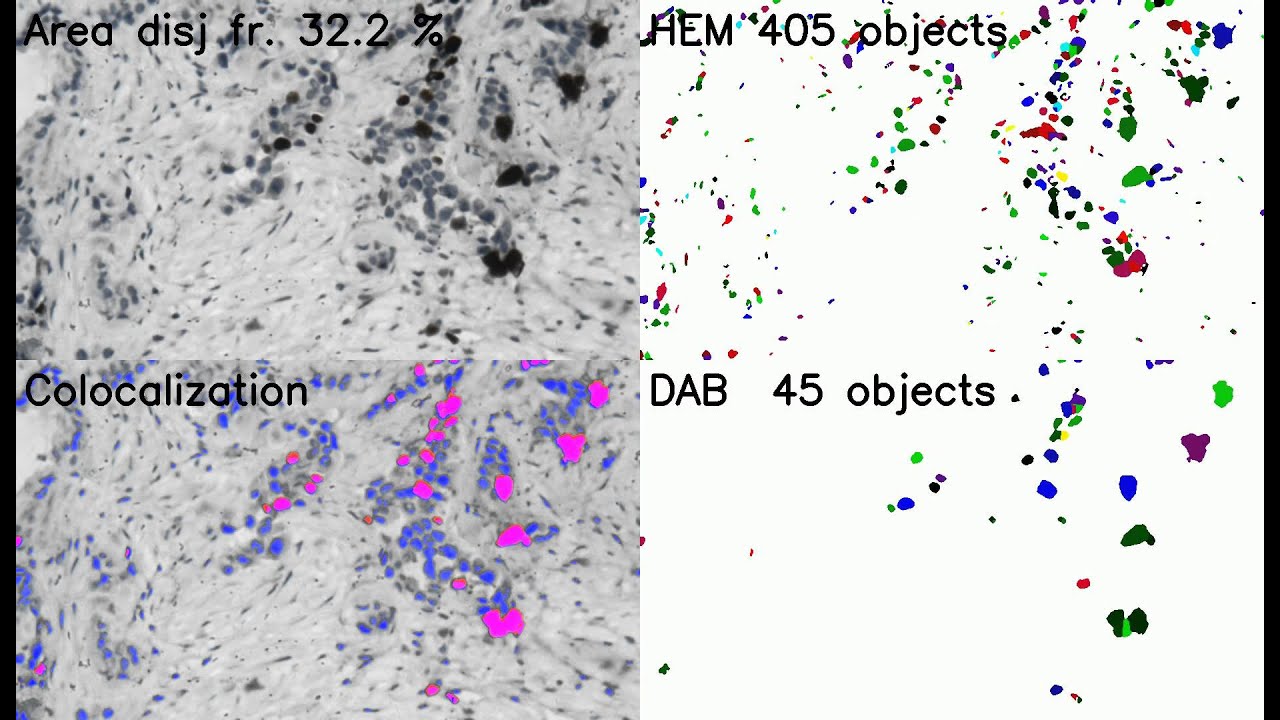 Ki67 labeling index in breast carcinoma slice (colorized)