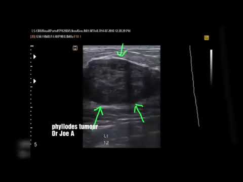 Phyllodes tumour breast 3D and 4D ultrasound