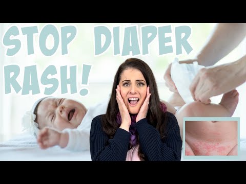 DIAPER RASH- Top Tips to Prevent & Treat Common Diaper Rashes!