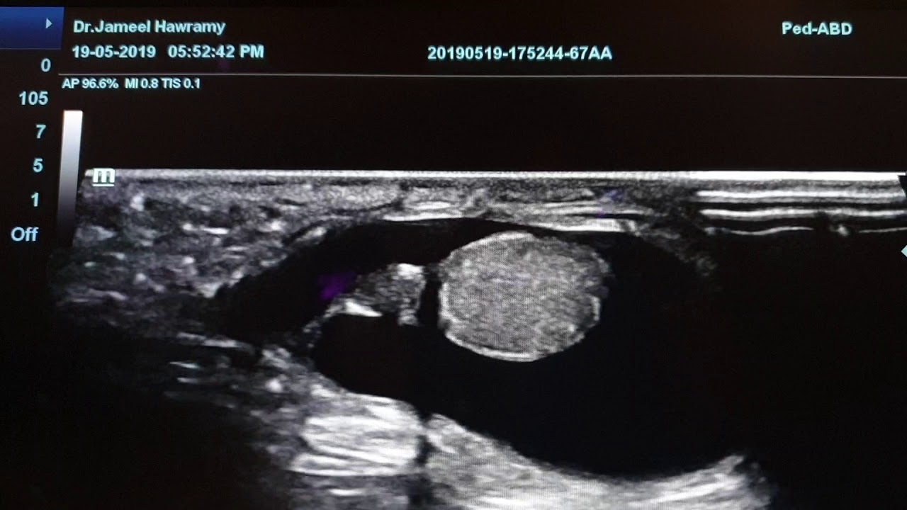 Bell Clapper Deformity Sonography
