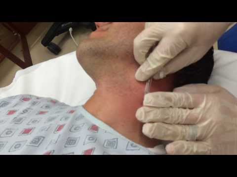 External Jugular IV Access – Combat Medicine 101