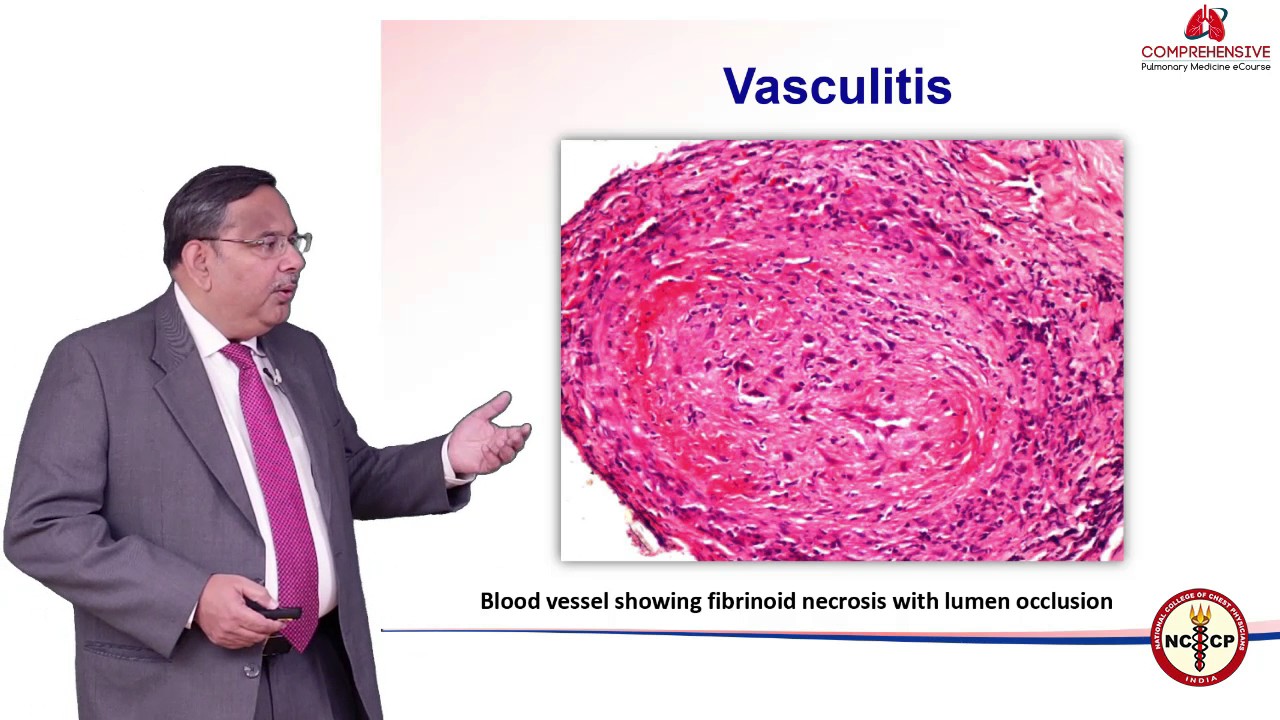 Pulmonary Vasculitis - Dr. Rohini Handa - Comprehensive Pulmonary Medicine eCourse