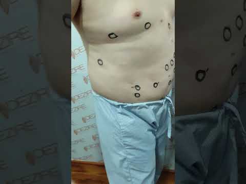 Lipoma | Lipoma Removal | Multipal Lipoma Removal #short #shortvideo