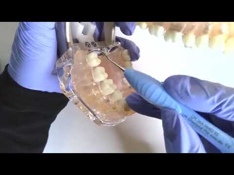 How to Use Diamond File Mesial-Distal LM™ hand instrument