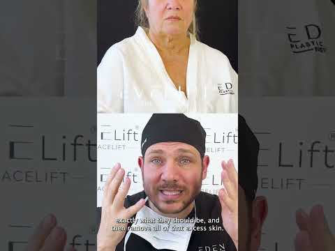 65-Year-Old EVE Lift™ Patient Before and Just One Day After | Dr. Ali Charafeddine, MD
