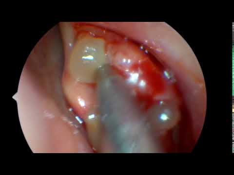 surgical video record by UC-100 USB HD endo camera, NSE