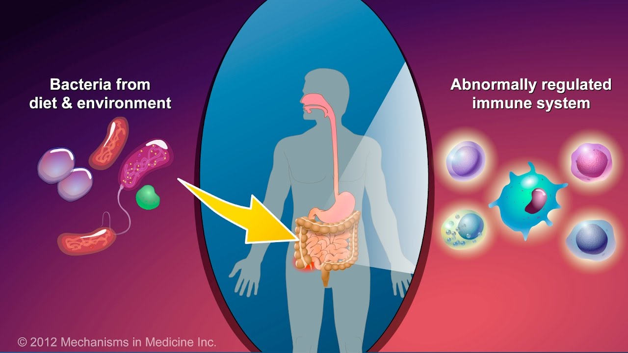 What is Crohn's Disease?