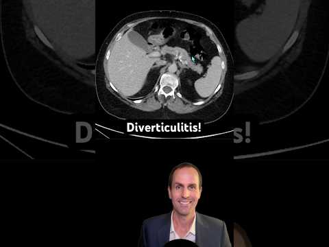 Abdominal CT Tutorials - Diverticulitis