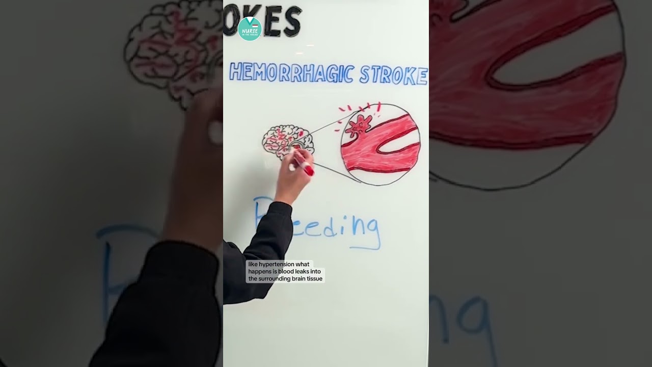 Types of Strokes 🧠 #RN #BSN #futurenurse