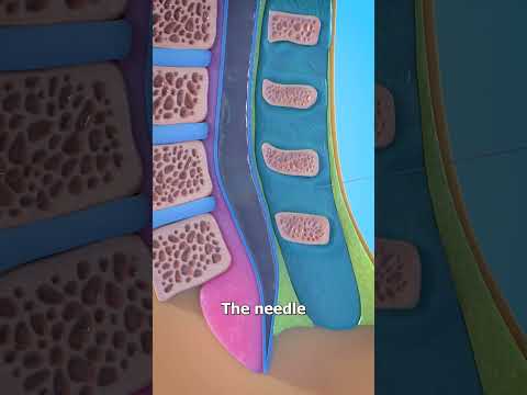 How A Spinal Tap Works π¨
