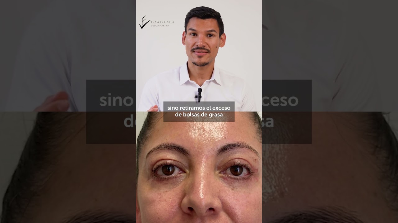 REEL 4 BLEFAROPLASTIA