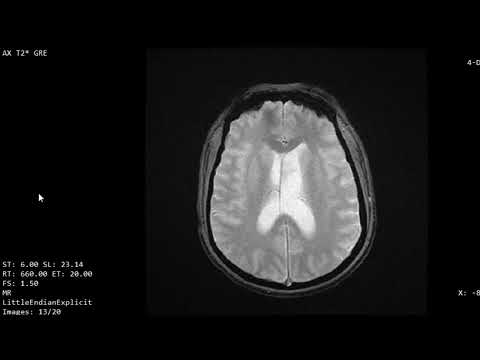 CASE 997 MRI SELLA MACROADENOMA