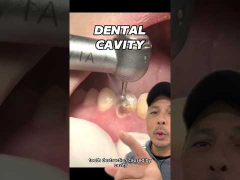 Removing BIG Cavity on Lower Bicuspid | In Office to Hands On Dental Training #shorts