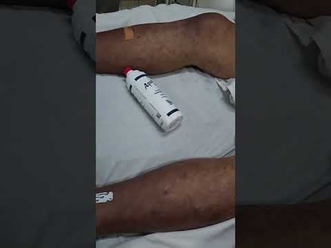 Skin Mottling