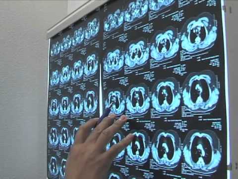 What is definition of asthma