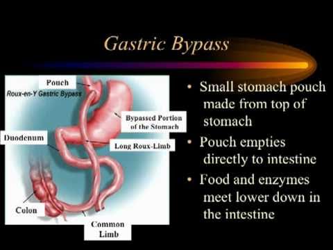 Introduction to Bariatric Surgery