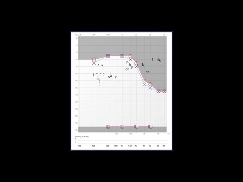 What do your hearing test results actually mean?