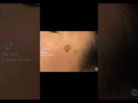 Treat Hyperpigmentation, Solar Lentigo (Sun Spots), and Dark Underarms #sunscreen #skincare #sun