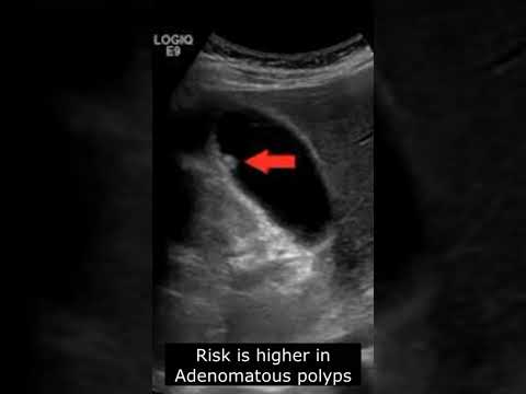 Gall bladder polyps - What to do?? #shorts #healthmedia