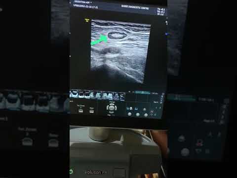 Chronic appendicitis