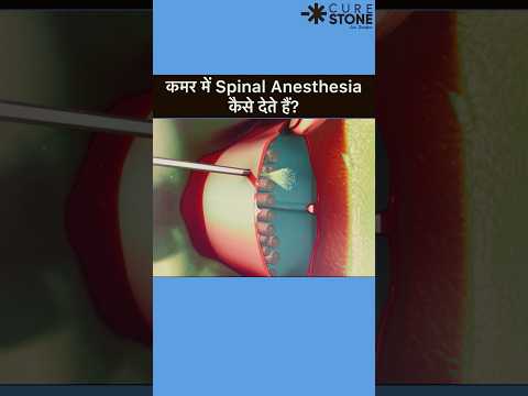 Spinal Anesthesia | How spinal is given | Epidural Anesthesia #rirssurgery #pregenency