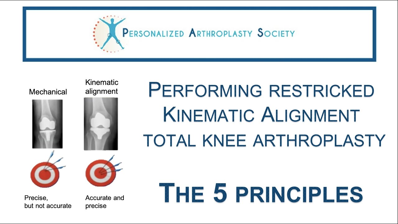 The 5 principles to perform restricted kinematic alignment total knee arthroplasty